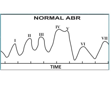 Normal Abr Waves Quiz