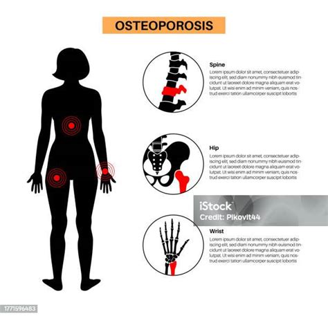 Ilustración De Póster Médico Sobre Osteoporosis Y Más Vectores Libres