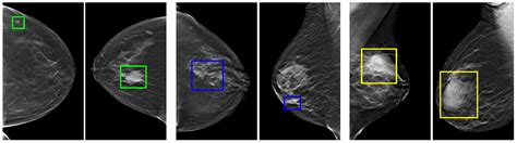 Detecting Breast Tumors In Tomosynthesis Images Utilizing Deep Learning Based Dynamic Ensemble