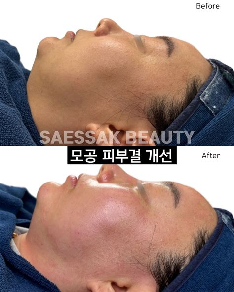전주피부관리 전주슈퍼젝션 효자동여드름 세멘팔트 새싹뷰티 축축처지는 피부 탄력관리 가능할까요🥹 전주슈퍼