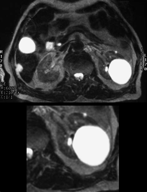 If Finding Cyst Simple Mri The Common Vein