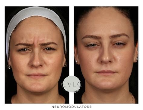 Patient 554660 Neuromodulators Botox And Dysport Before And After