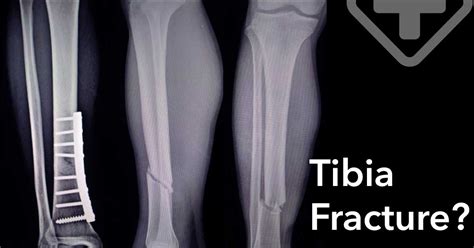 Tibia Fracture Causes Symptoms Diagnosis And Treatment Tibia Fracture Causes Symptoms Diagnosis And Treatment