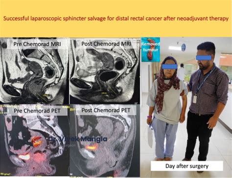 Intersphincteric Resection A Technique To Restore Normal Passage For Stools In Appropriate