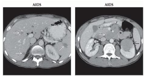 Da8 Db1 Splenomegaly Ffu4  Abdominal Key
