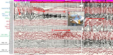 Ictal Eeg During Video Ieeg Monitoring Amy Amygdala Hip