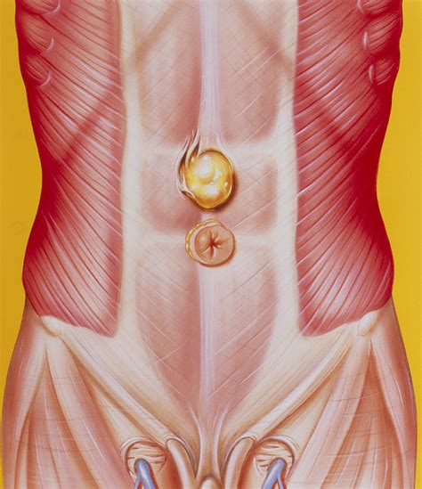 4 Tipos De Hérnia Da Parede Abdominal Dr Christiano Claus