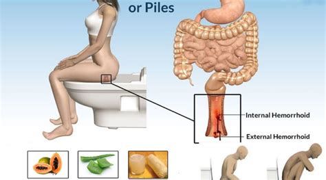 Piles Treatment Archives Sex And Penis Size Enlargement Medicine Tablets