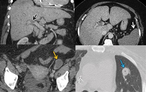 Imaging Spectrum Of Granulomatous Diseases Of The Abdomen And Pelvis
