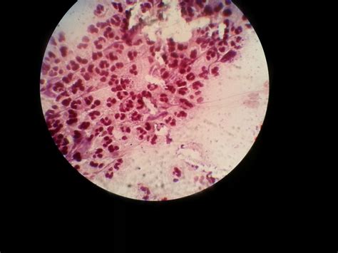 Gram Negative Diplococci