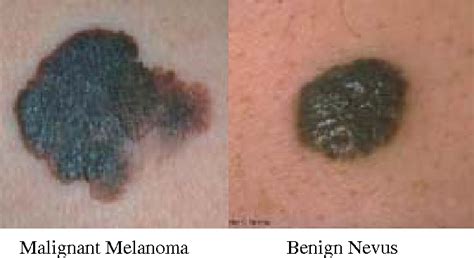 Figure 1 From Identification Of Malignant Melanoma By Wavelet Analysis