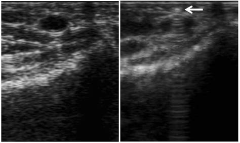 Left Sca Aneurysm Pipeline Embolization Left Radial Accesss
