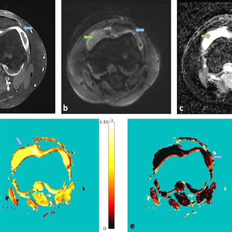Persisting Synovitis Of The Left Knee Joint Under Anti Inflammatory Download Scientific Diagram