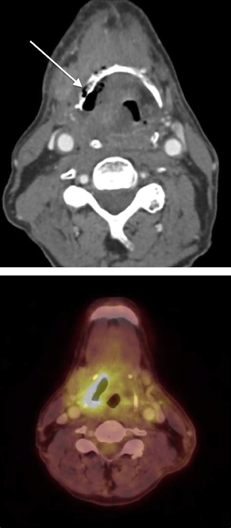 Imaging For Larynx Cancer Assessment Operative Techniques In