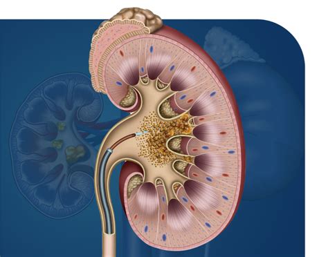 Lithotripsy Procedure