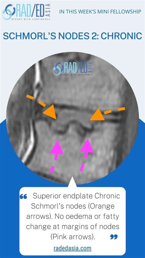 Schmorls Node On Spine Mri Acute And Chronic Schmorls Nodes Mri