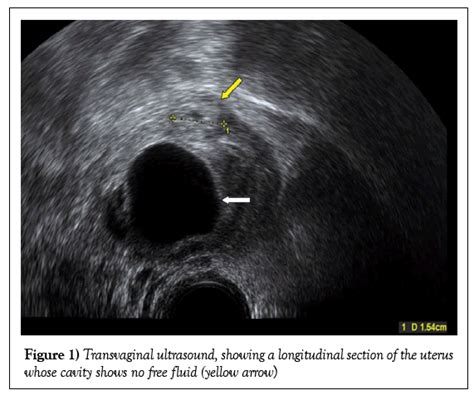 Ovarian Ectopic Pregnancy Transvaginal Ultrasound Showing