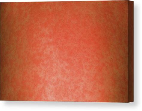 Rubeola Rash