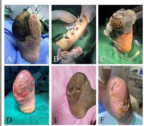 David Armstrong On Linkedin Modified Tibial Cortex Transverse Transport Ttt Yet More