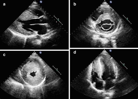 Restrictive Cardiomyopathy Transthoracic Echocardiogram