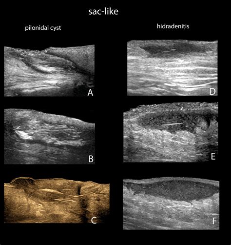 Image Pilonidal Cyst Pilonidalsinusexzision Xaky
