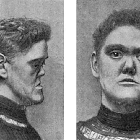 Sexually Transmitted Infections Part 2 Syphilis Caustic Soda