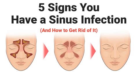 Sinusitis Antibiotics Guidelines