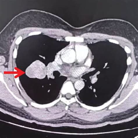 Contrast Enhanced Computed Tomography Thorax Showed Relatively