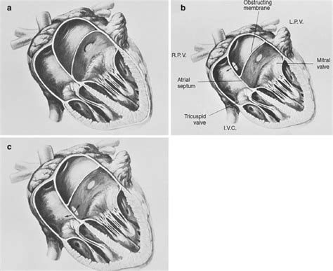 Complications Associated With Repair Of Cor Triatriatum Springer