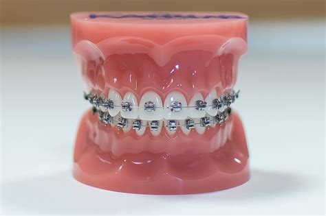 Train Track Braces Fixed Orthodontic Appliances 3dental In Dublin