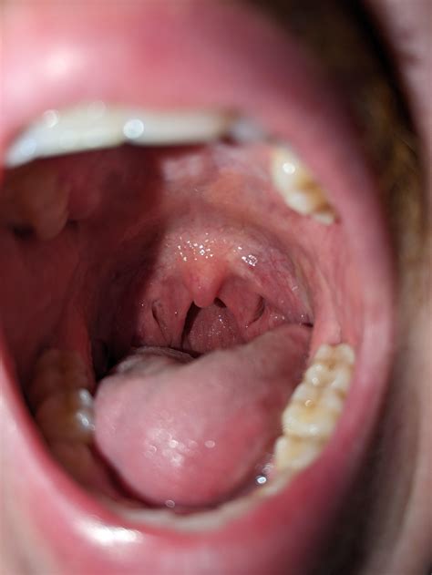 Strep Tonsillitis R Medical