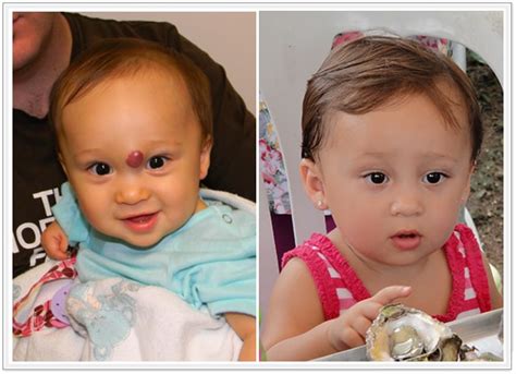 New York Hemangiomas Before And After Photos Los Angeles