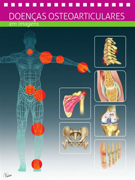 Doenças Osteoarticulares Tipos E Tratamentos Pdf Osteoartrite