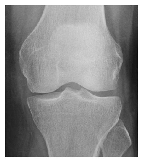 Proximal Metaphyseal Fatigue Fracture Of The Tibia In A 27 Year Old Download Scientific Diagram