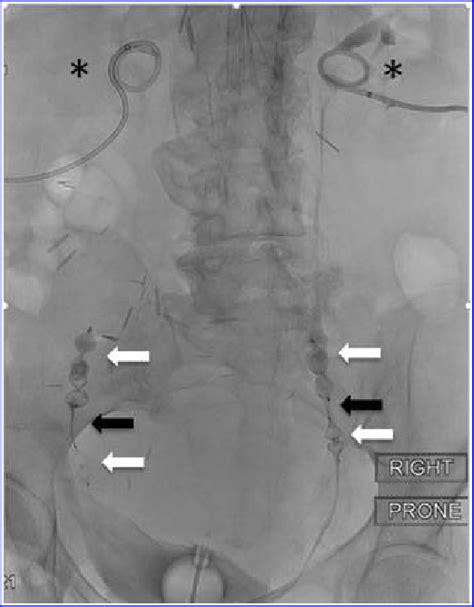 Final Fluoroscopic Image Demonstrates Effective Bilateral Ureteral