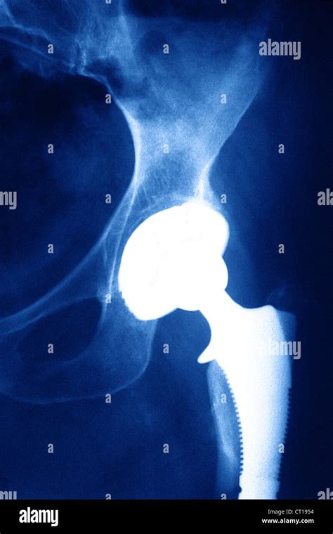 Hip Prosthesis X Ray Stock Photo Alamy