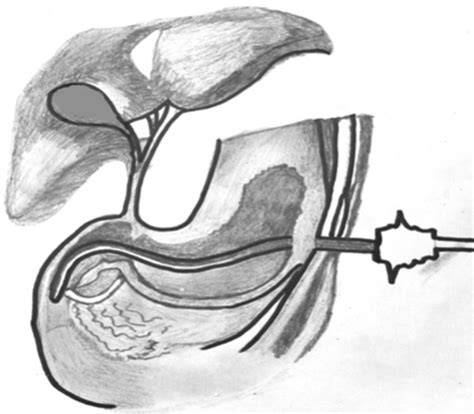 Laparoscopic Gastrotomy Access For Ercp Download Scientific Diagram