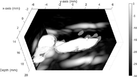 Figure 1 From 3 D Super Resolution Ultrasound Imaging Using A 2 D Sparse Array With High