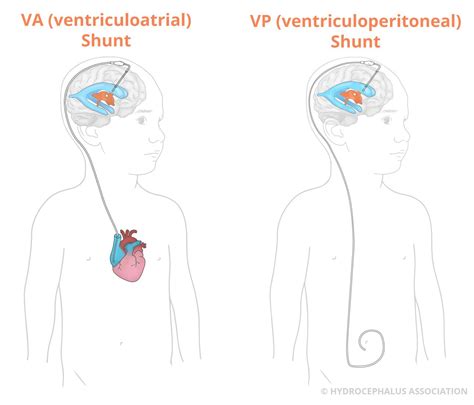 How Common Is Hydrocephalus