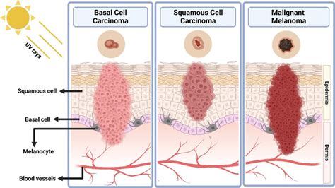Squamous Cell Carcinoma Diagram