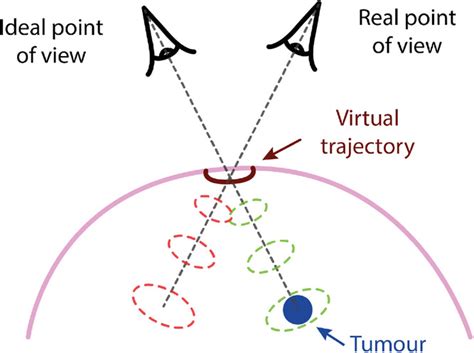 Visualization Modality For Augmented Reality Guidance Of In‐depth Tumour Enucleation Procedures