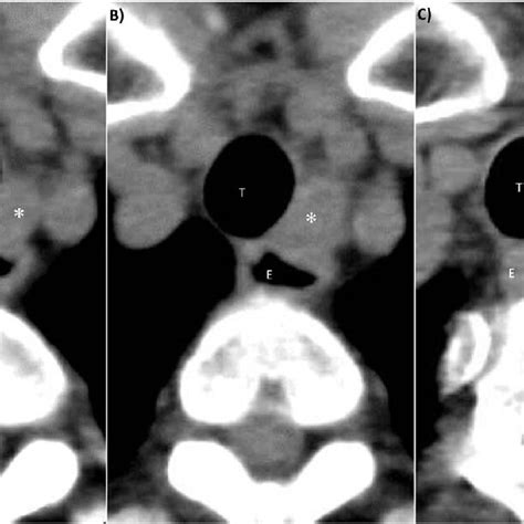 Ct Findings Of Left Iii Lymph Node Metastasis A 4 Years After Download Scientific Diagram