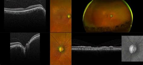Monaco Glaucoma Rg Oct Retinal Onh