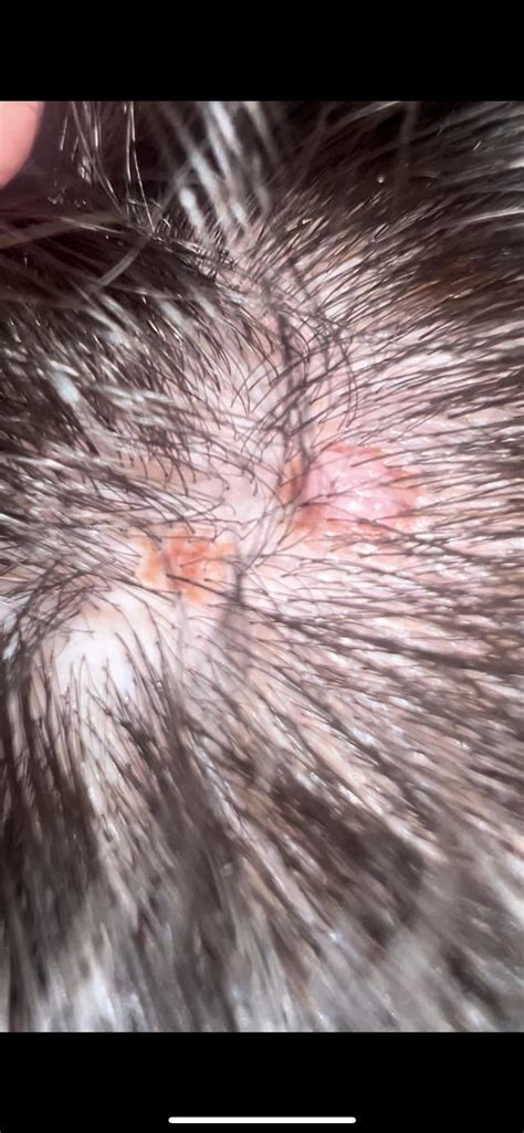 Scalp Bump Rdermatologyquestions Scalp Bump Rdermatologyquestions