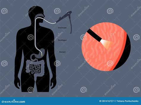 Gastroscopy Endoscopy Procedure Cartoon Vector 281340701