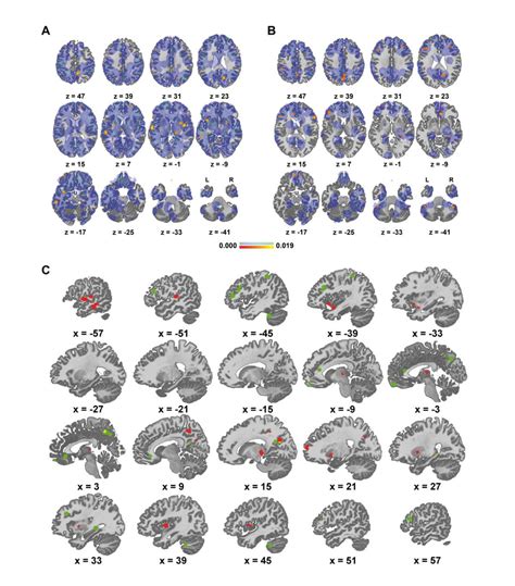Areas Of Altered Functional Connectivity Activity In Depression