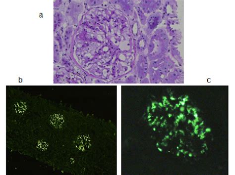 Histopathology Of Iga Nephropathy A Light Microscopy Showing One Download Scientific Diagram