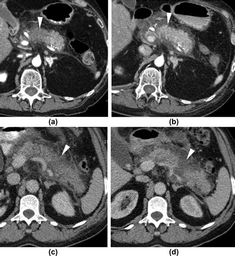 Acute Pancreatitis International Classification And Nomenclature Clinical Radiology