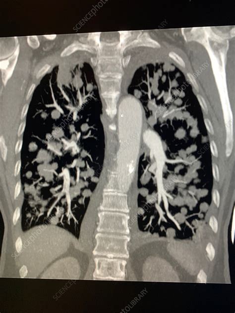 Lung Metastasis Ct Reconstruction Stock Image C0584493 Science