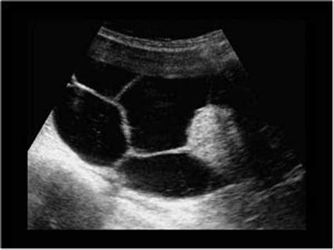 Gynaecology 32 Adnexa Case 321 Benign Cystic Lesions
